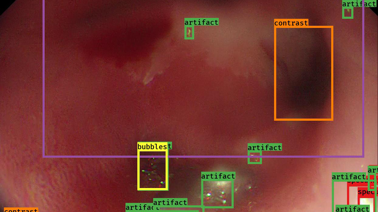 Using AI to improve the quality of endoscopy videos | NIHR Oxford ...