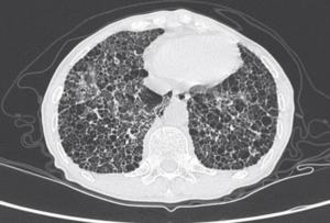 Sub-theme 2: Interstitial lung disease (IPF and fibrotic sarcoidosis ...