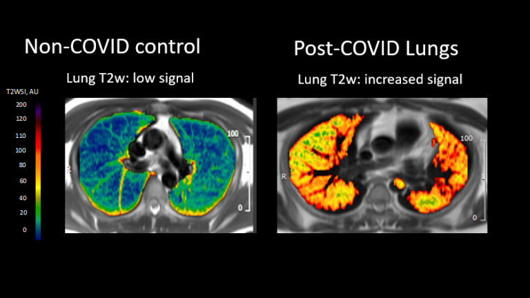 Longer-term organ abnormalities confirmed in some post-hospitalised ...