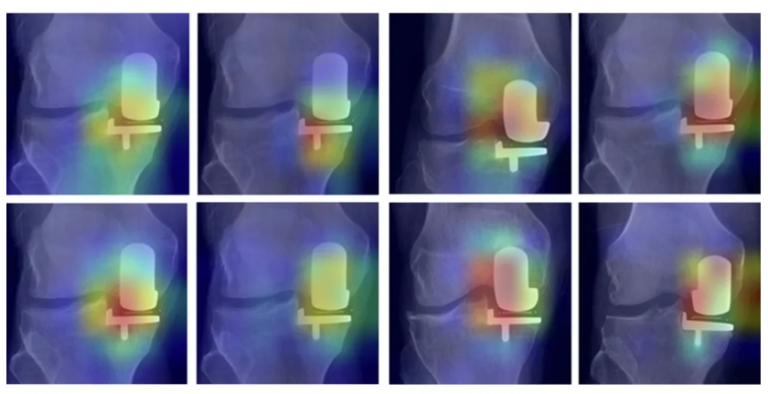 Machine Learning Outperforms Surgeons In Predicting Knee Replacement